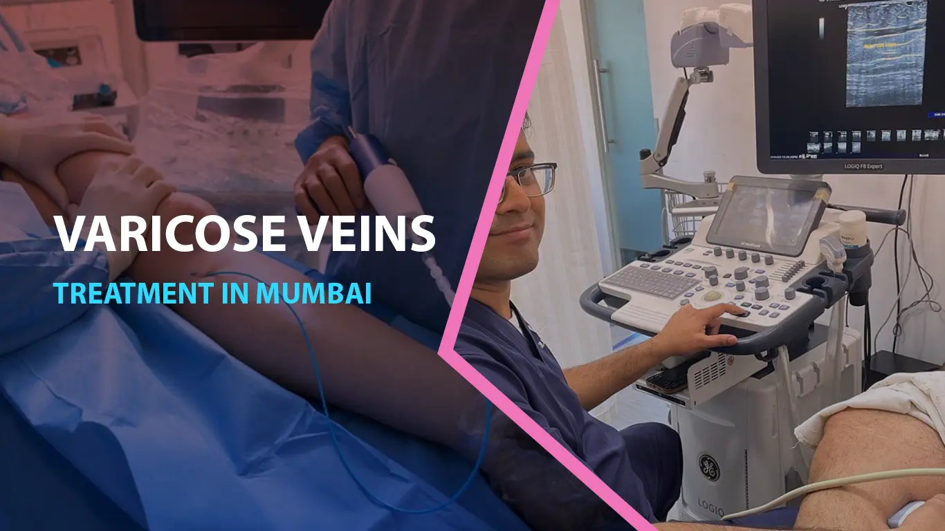 Varicose Veins Treatment in Mumbai | The Vein Center